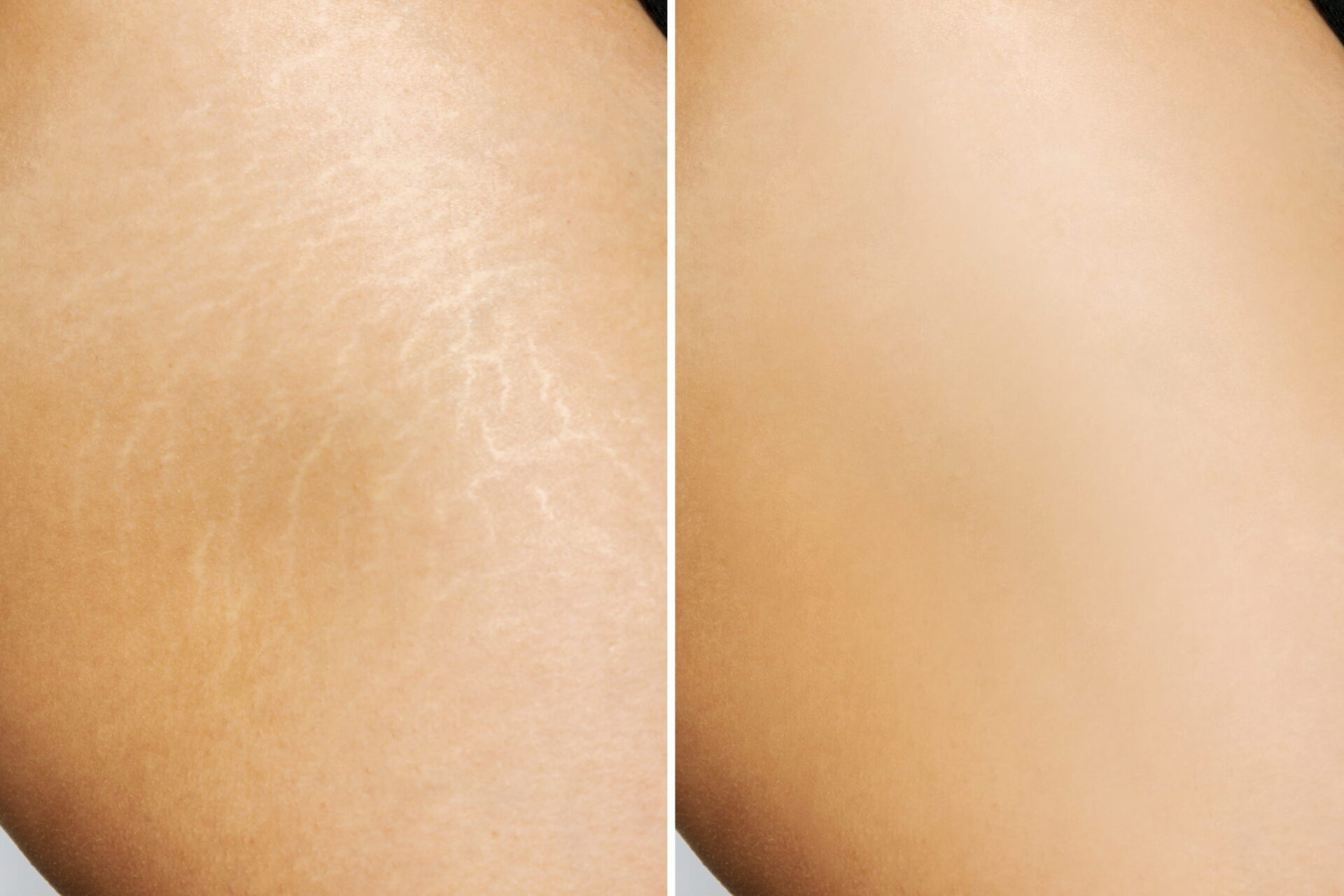 Laster Stretch Mark Removal In Atlanta, GA