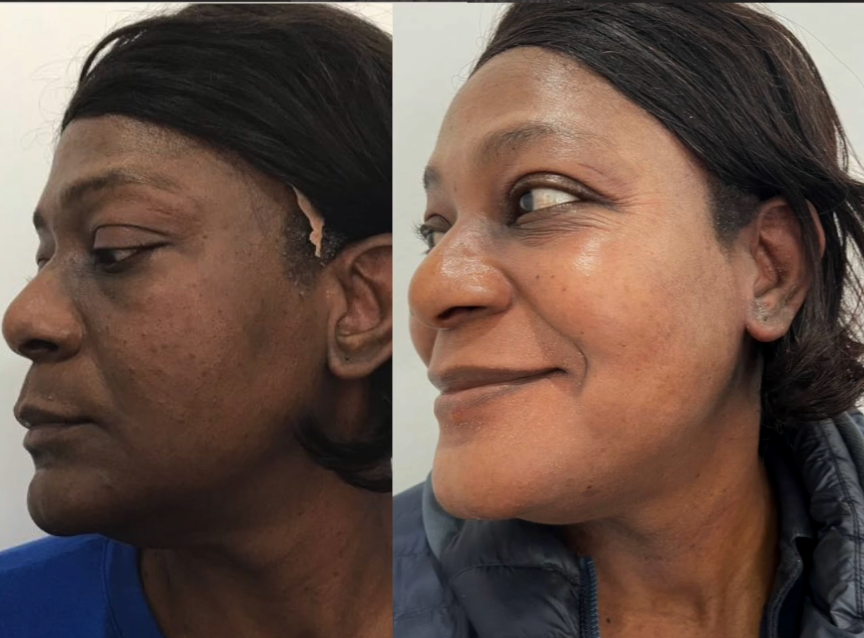Brightening Laser Facial & Spot Treatment Lightening Atlanta